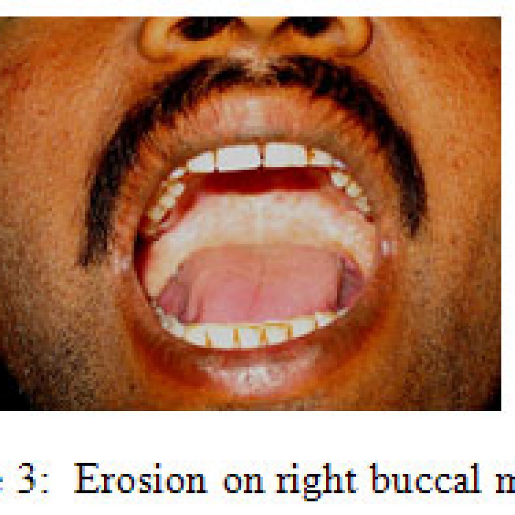 Oral Manifestation in Tuberculosis Disease: A Case Report – Biosciences ...