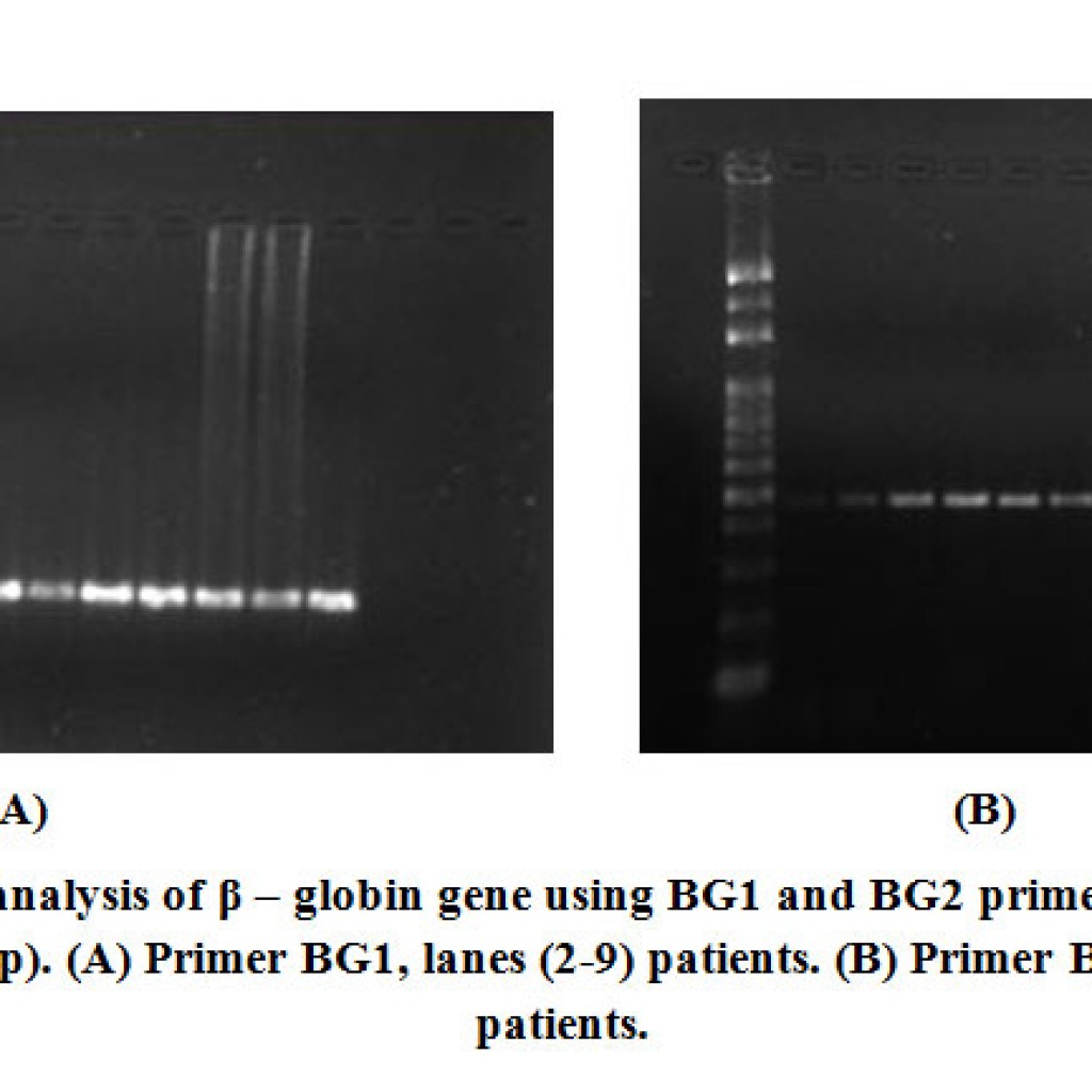 Prognosis of an Inherited Beta Globin Deficiency in Sickle Cell Anemic ...