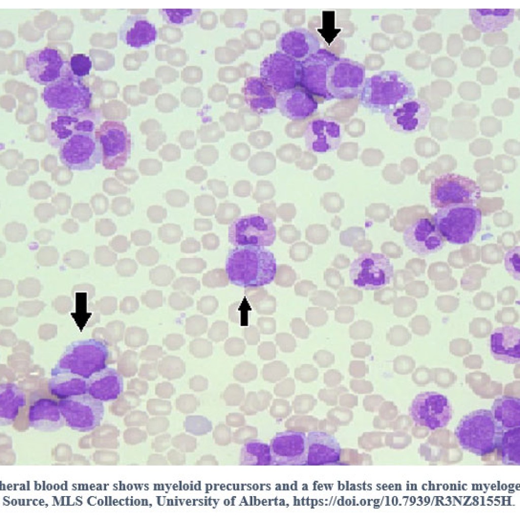 Overview of Molecular Quantification of the BCR-ABL Oncogene in CML ...