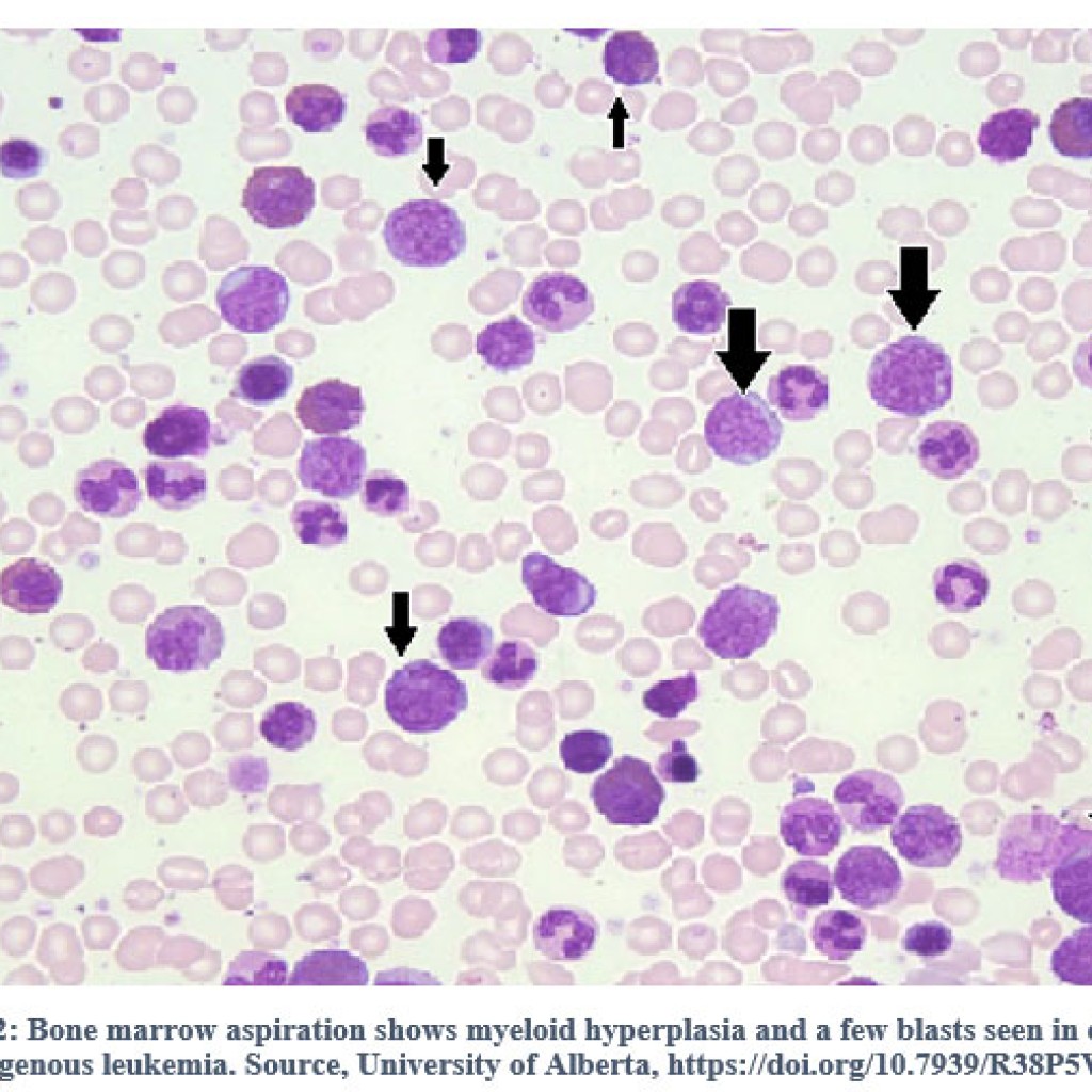 Overview of Molecular Quantification of the BCR-ABL Oncogene in CML ...