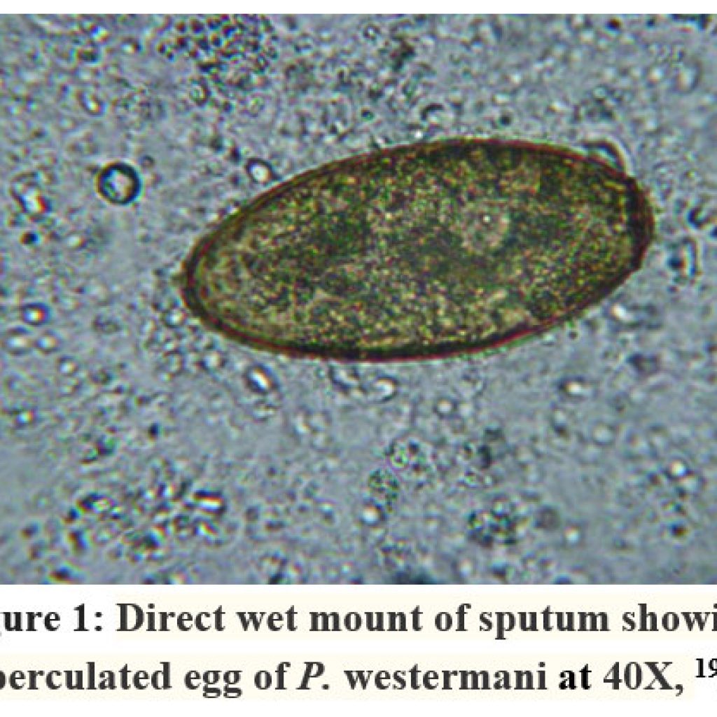 A Review on Paragonimiasis and its Differential Diagnosis Technique ...