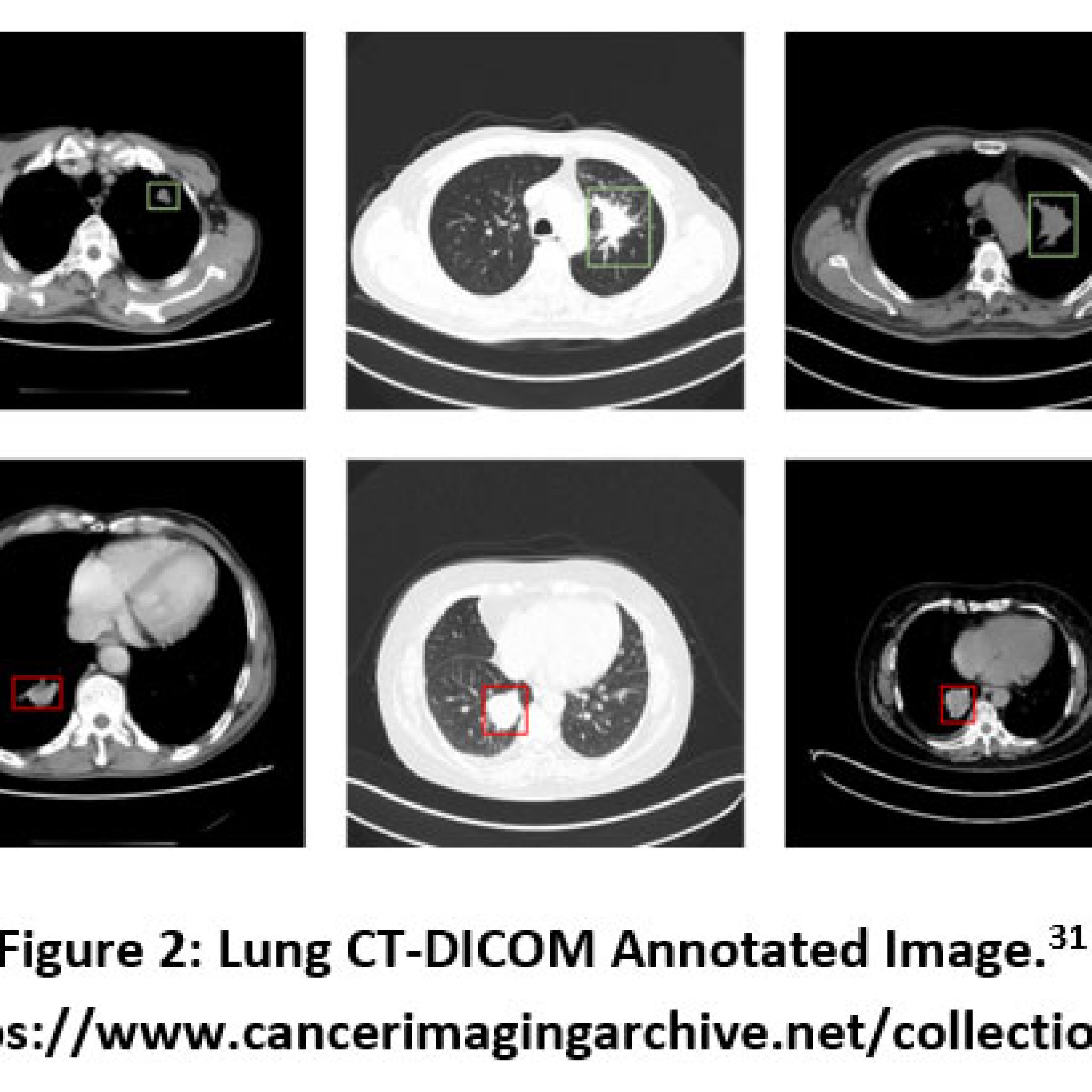 Quantum Enhanced Deep Learning Bio Inspired Model for Lung Tumors ...